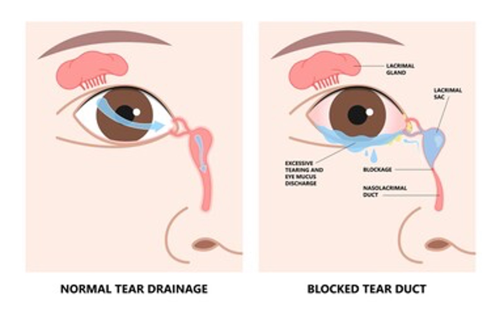 Blocked tear duct/ Sticky eyes in babies and young children – Cheshire ...